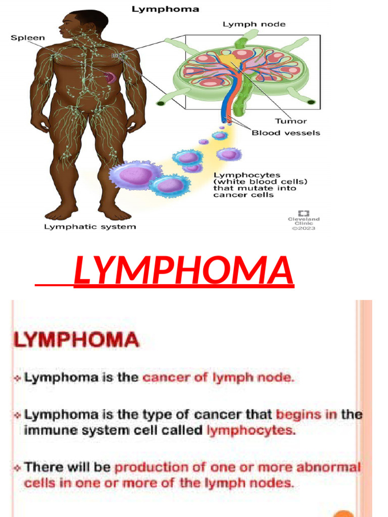 Lymphoma | PDF