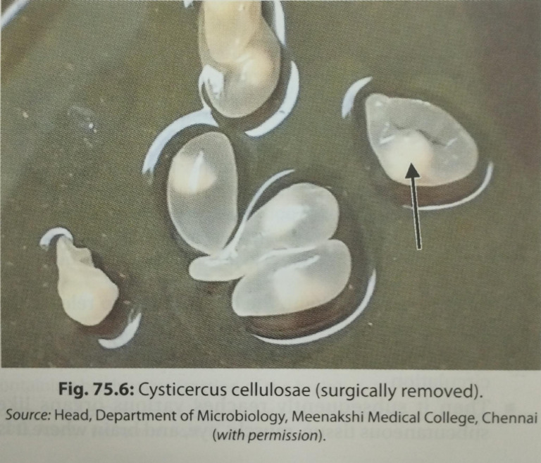 Surgically Removed Cysticercus Cellulosae | PDF