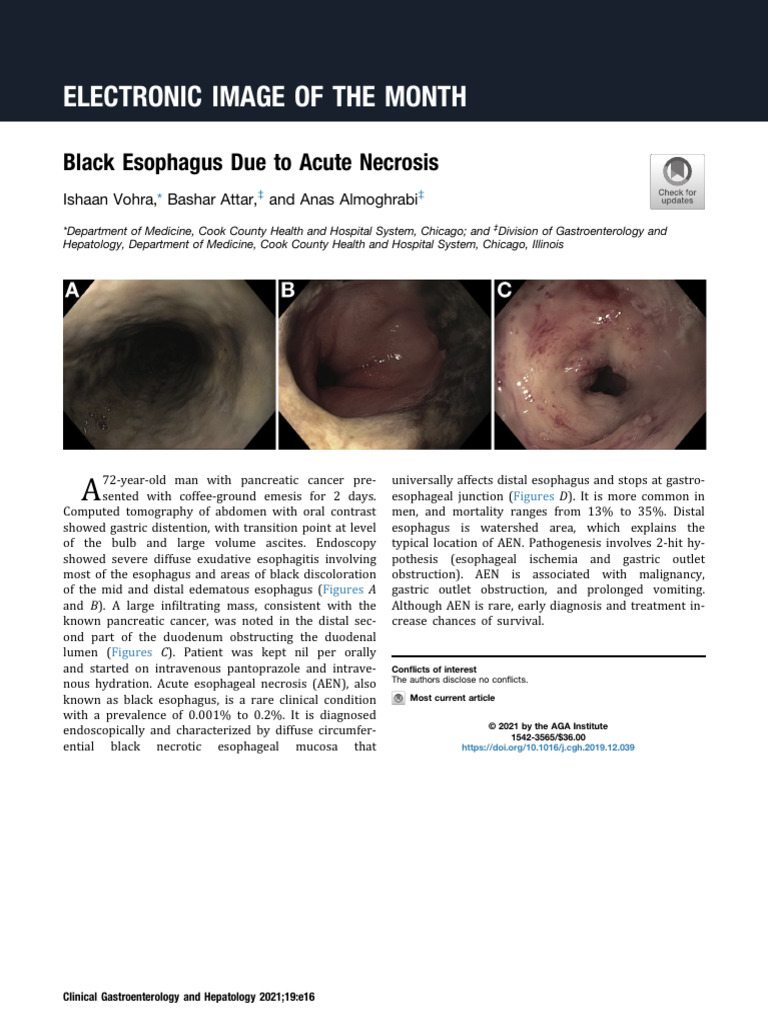 Black Esophagus: Acute Necrosis Case Study | PDF