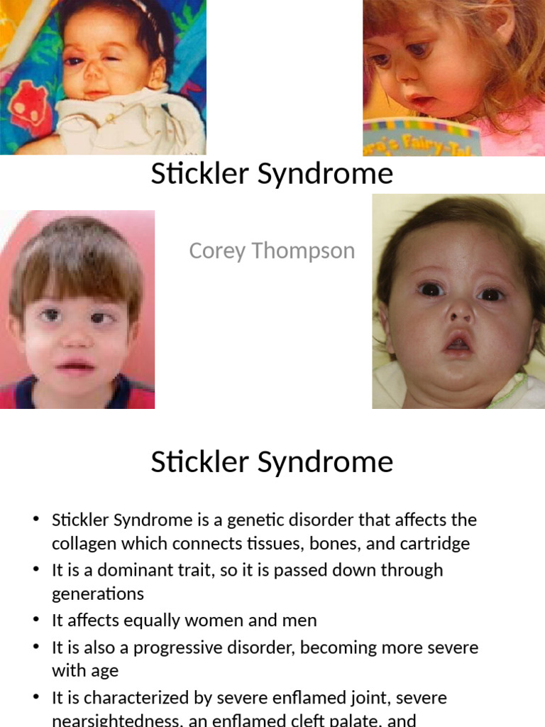 Stickler Syndrome | PDF | Health Sciences | Medicine