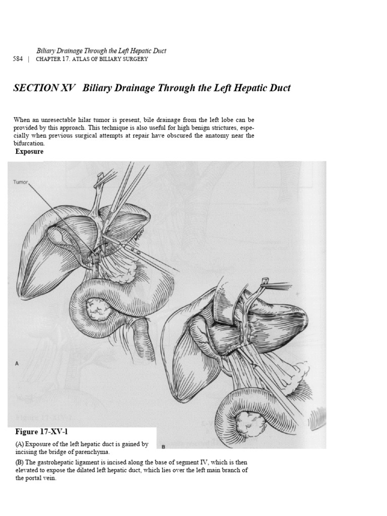 Biliary Drainage Through The Left Hepatic Duct | PDF