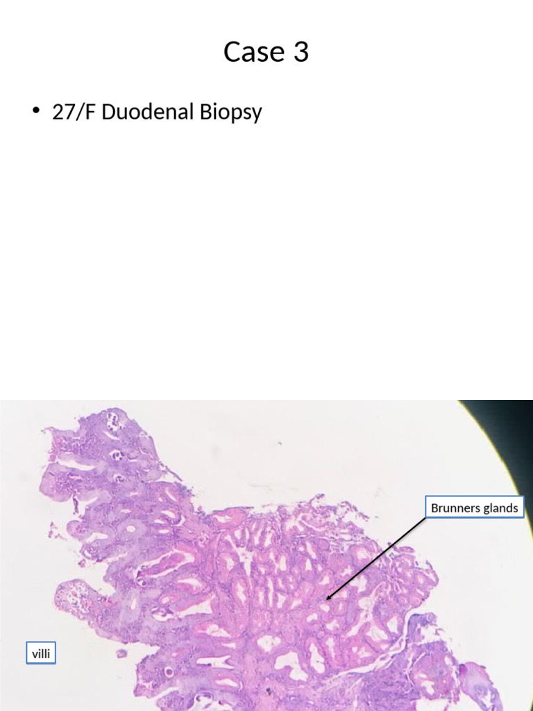 Duodenal Biopsy Seminar Presentation | PDF
