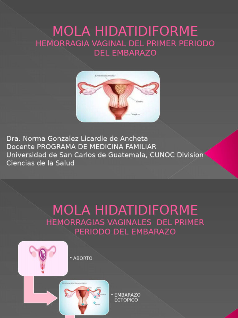 Mola Hidatiforme y Hemorragia Vaginal | PDF | El embarazo | Metástasis