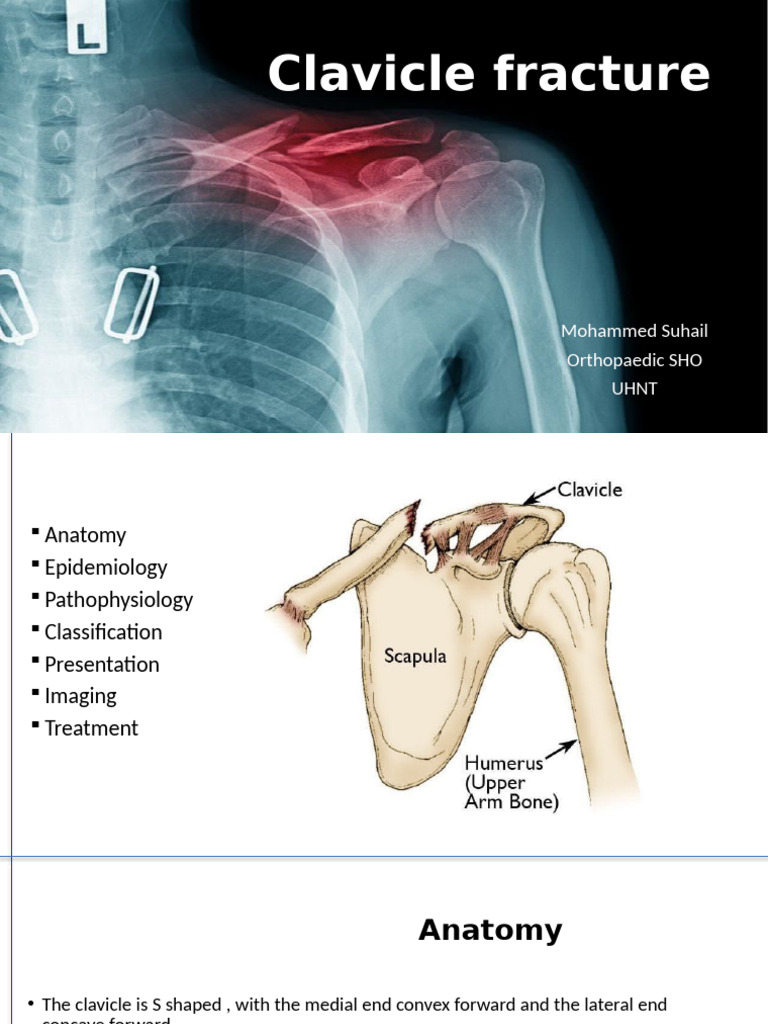 Claviclefracture | PDF | Skeletal System | Musculoskeletal Disorders