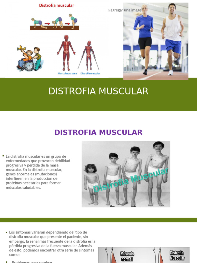 Distrofia Muscular | PDF