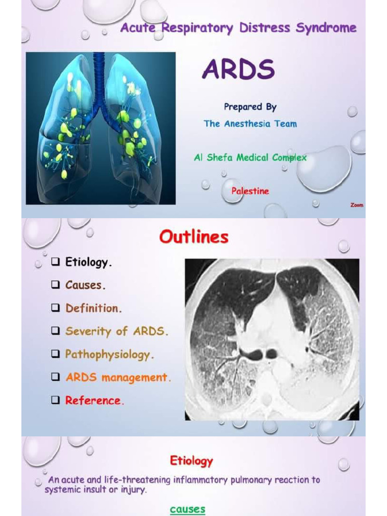 ARDS | PDF