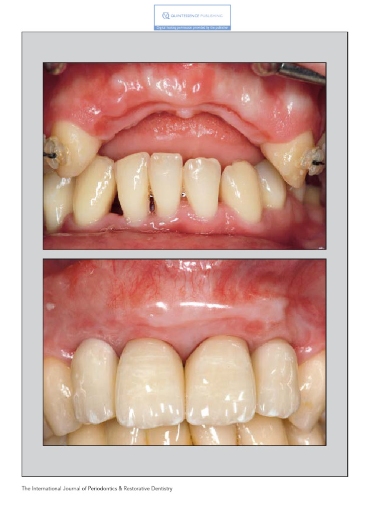 Vertical Ridge Augmentation and Soft Tissue Reconstruction of The ...