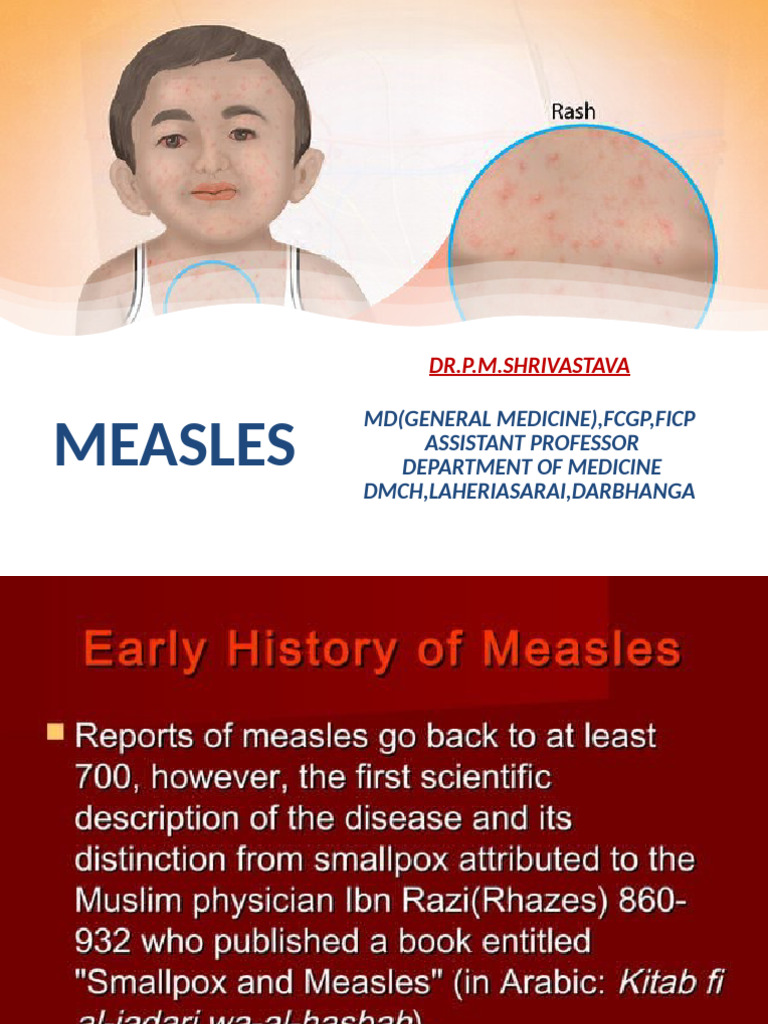 Measles | PDF