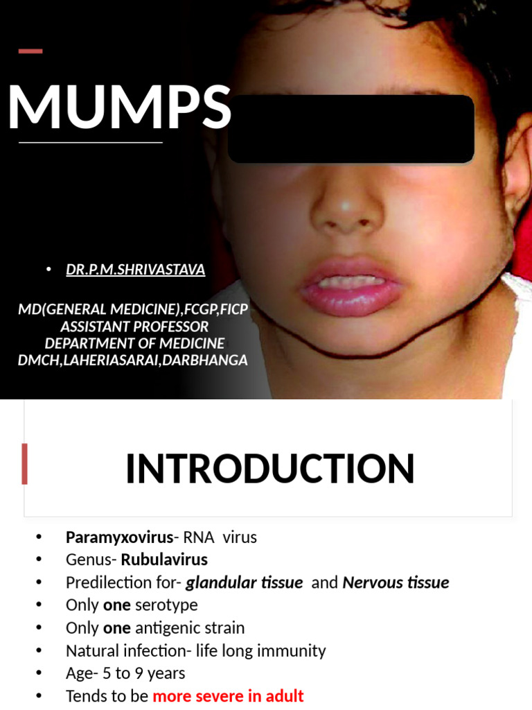 Mumps | PDF