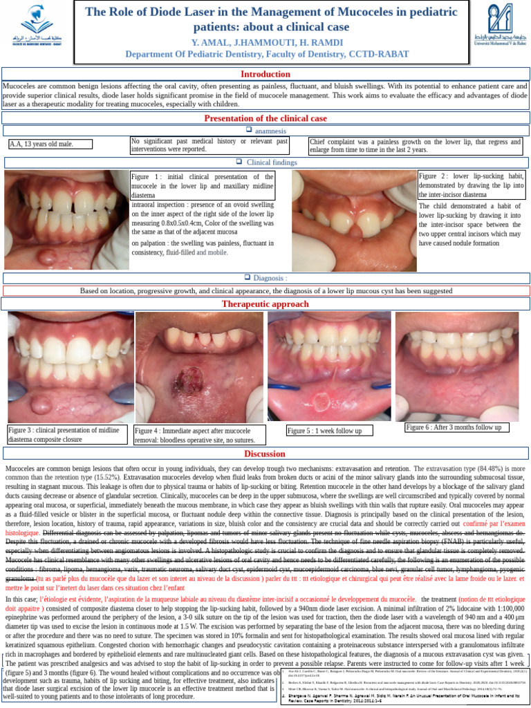 The Role of Diode Laser in the Management of Mucoceles in pediatric ...