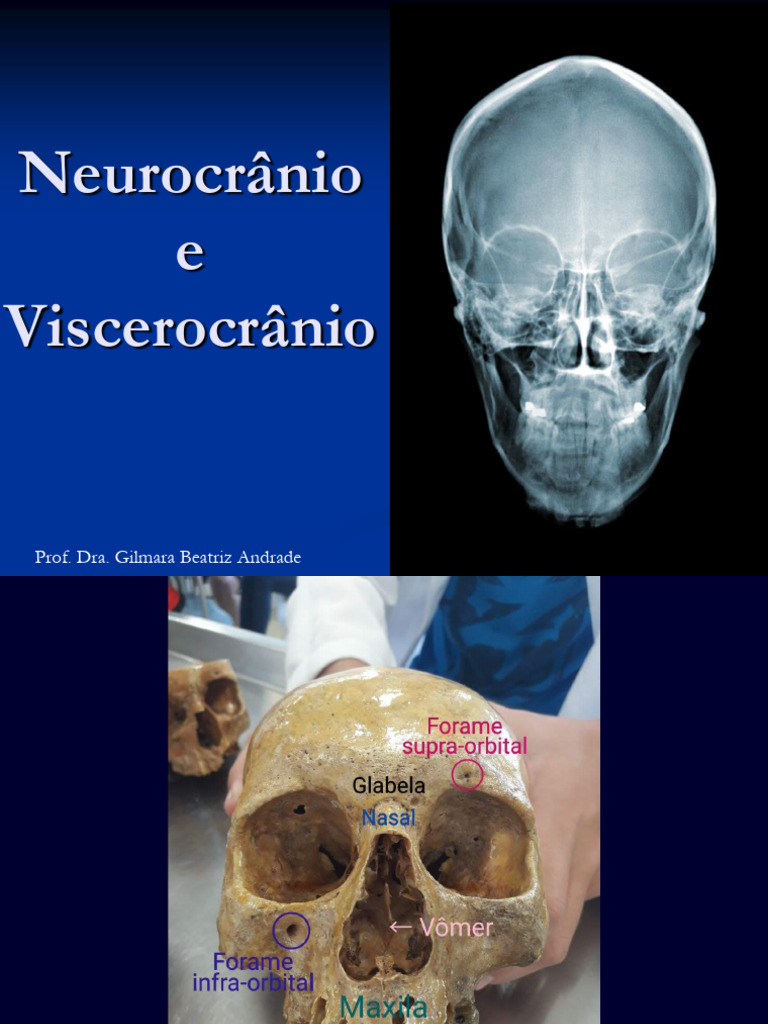 Neurocranio Viscerocranio Unit | PDF | Crânio | Sistema Esquelético