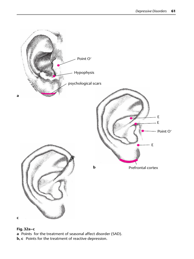Nogier, - Raphaël - Auriculotherapy 71 | PDF