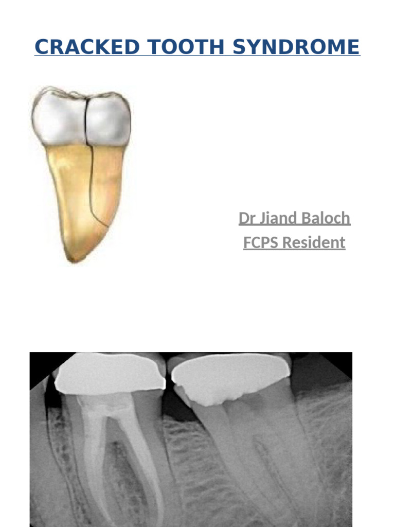 CRACKED TOOTH SYNDROME Lectre | PDF | Dentistry Branches | Dentistry