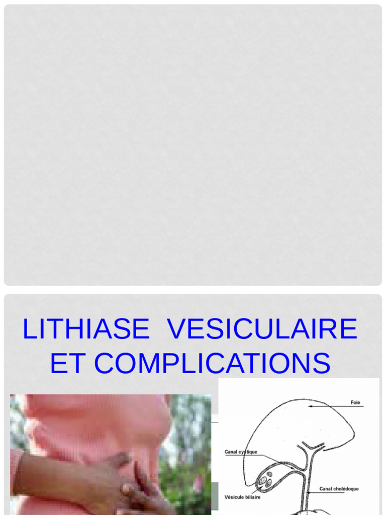 Lithiase Vésiculaire : Symptômes et Traitements | PDF | Vésicule biliaire | Spécialités médicales