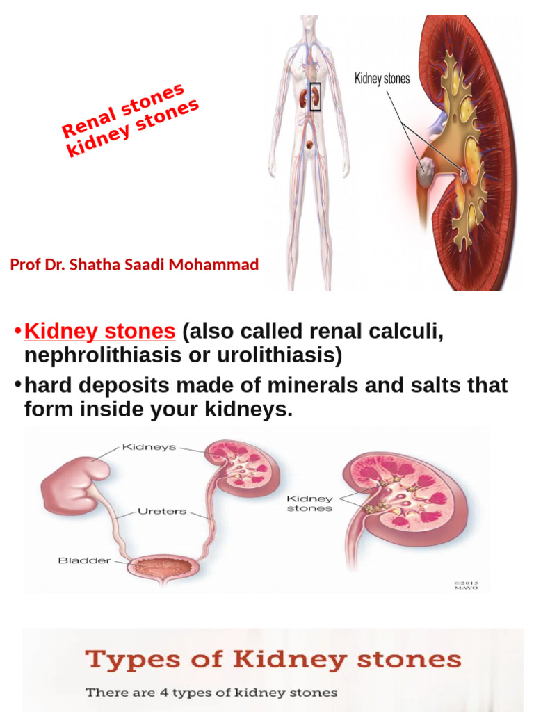 Renal Stone | PDF | Diseases And Disorders | Clinical Medicine