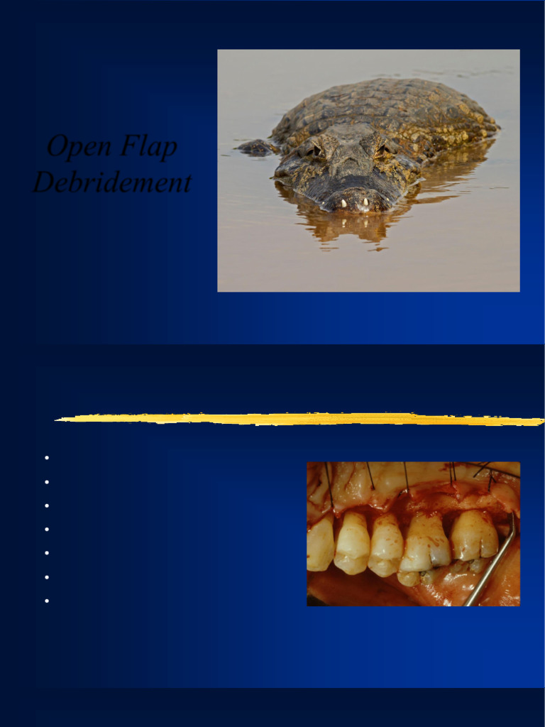 Lecture 4 - Open Flap Debridement - 2024 | PDF | Periodontology ...