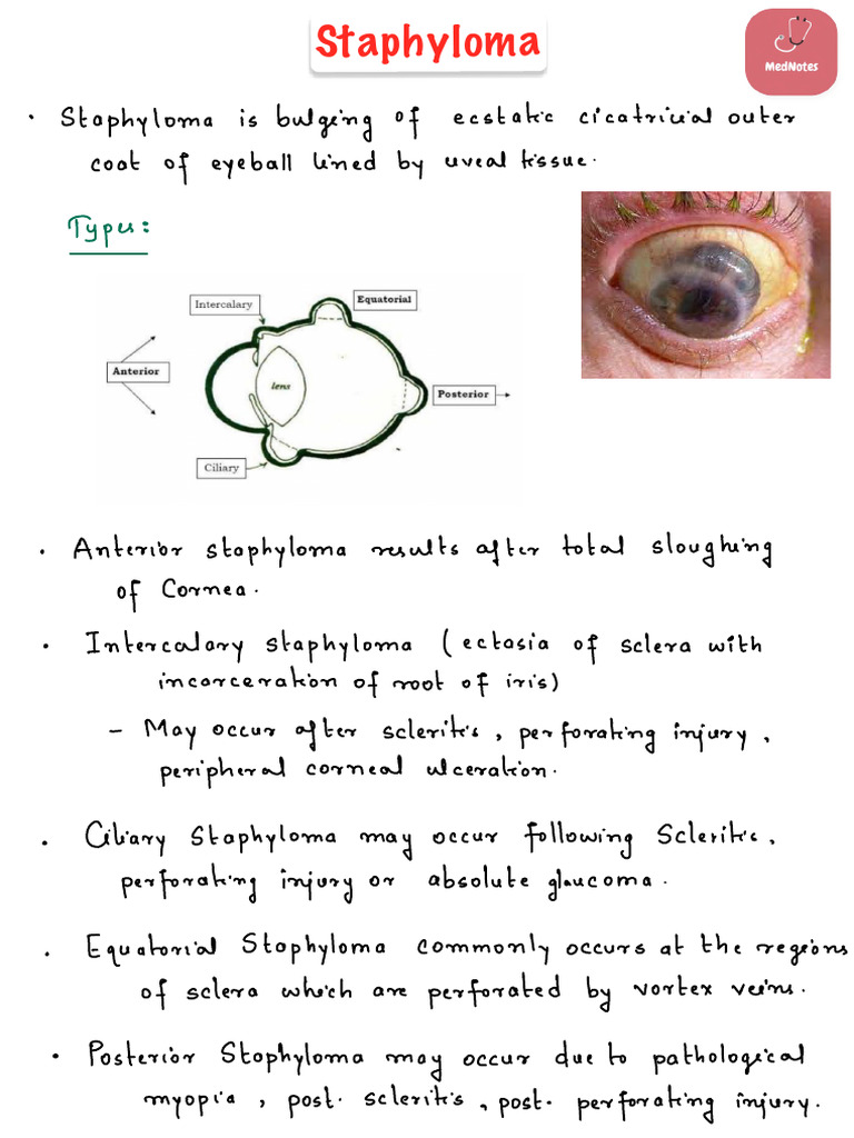 2. Staphyloma | PDF | Medical Specialties | Vision
