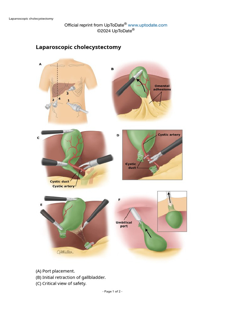 Laparoscopic Cholecystectomy | PDF