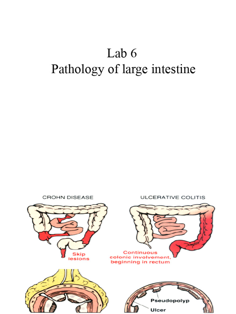 Large Intestine Pathology Lab | PDF | Adenoma | Ulcerative Colitis
