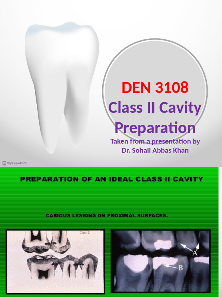 DEN 3108 Class II Cavity Preparation | PDF
