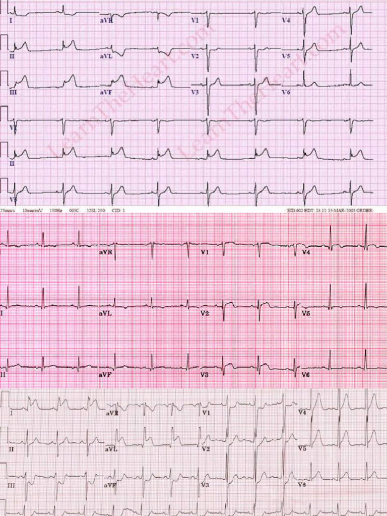 STEMI ECG 2024 - 12 - 24 16 - 03 Office Lens | PDF