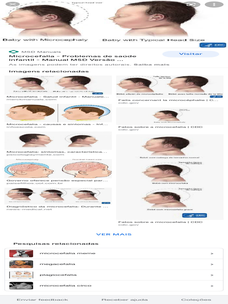 Microcefalia Leve - Pesquisa Google | PDF