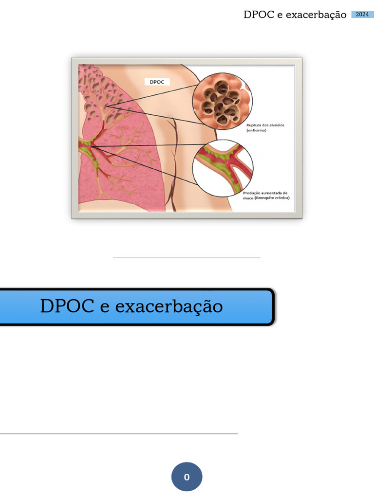 DPOC: Causas, Sintomas e Diagnóstico | PDF | Doença de obstrução ...