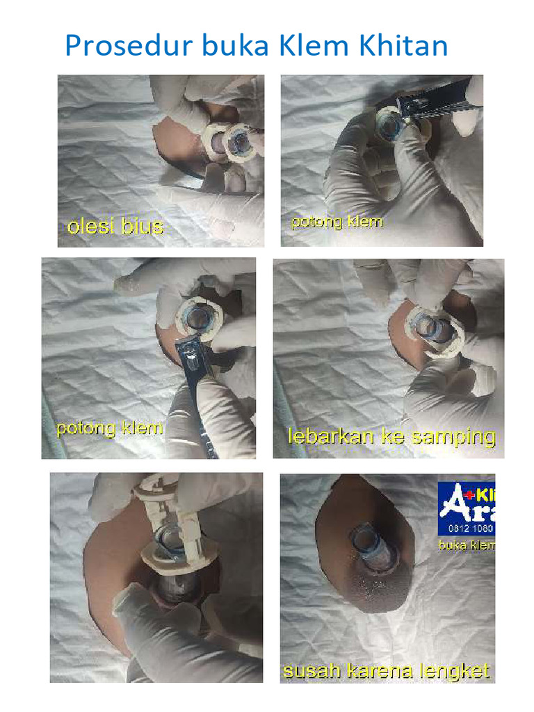 buka Klem Khitan Klinik Aras | PDF