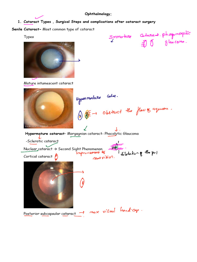 Imp Topics Opthal Explained by RG | PDF | Cataract | Glaucoma