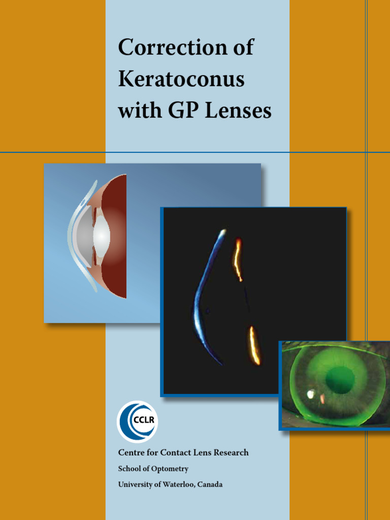correction-of-keratoconus-en | PDF | Contact Lens | Eye