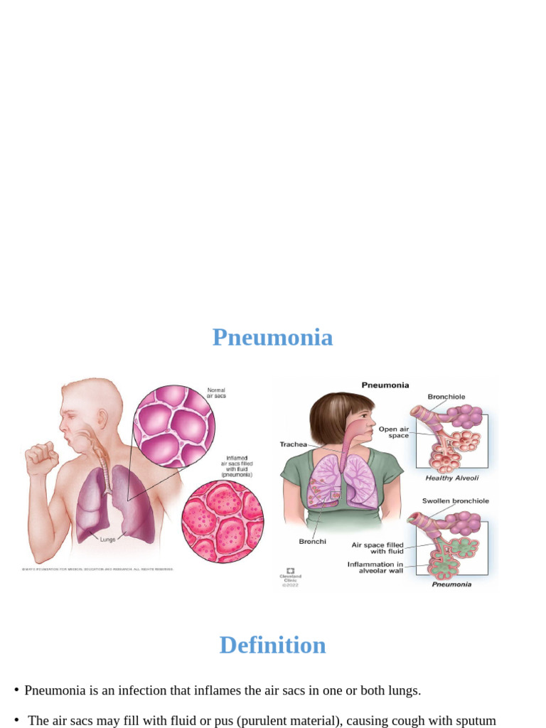 Pneumonia | PDF | Pneumonia | Health Sciences