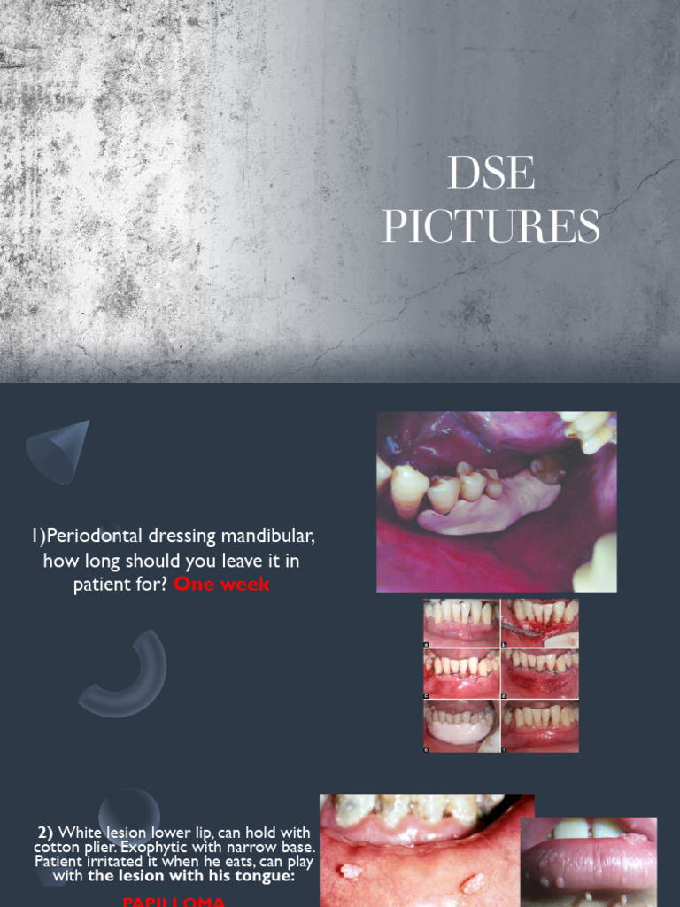 DSE Pictures | PDF | Dentures | Clinical Medicine