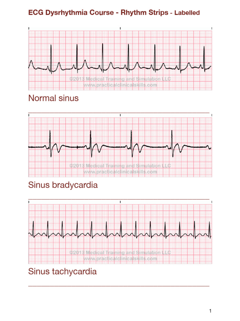 ECG Interp Strips-labelled-PDF Format | PDF | Internal Medicine | Heart