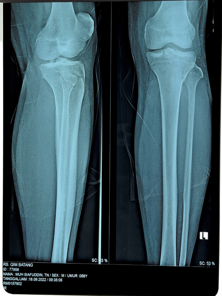 Tibial Plateau Fracture | PDF
