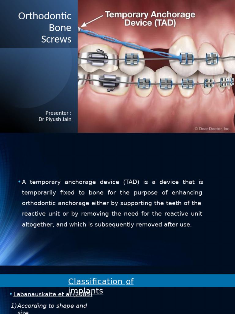 Orthodontic Bone Screws | PDF | Dental Implant | Bone