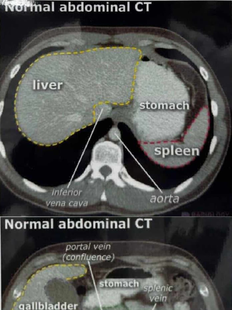 Normal Abdominal CT Scan Findings | PDF