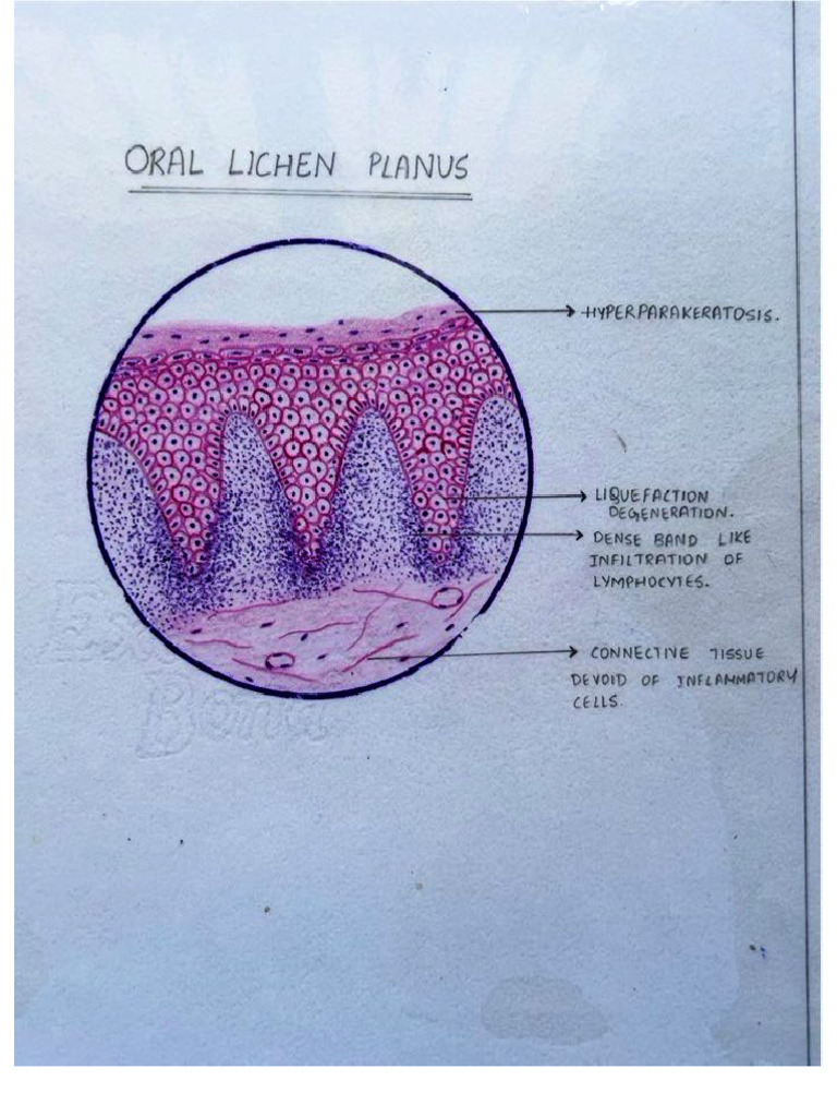 Oral Lichen Planus, Pemphigus, Pemphigoid | PDF