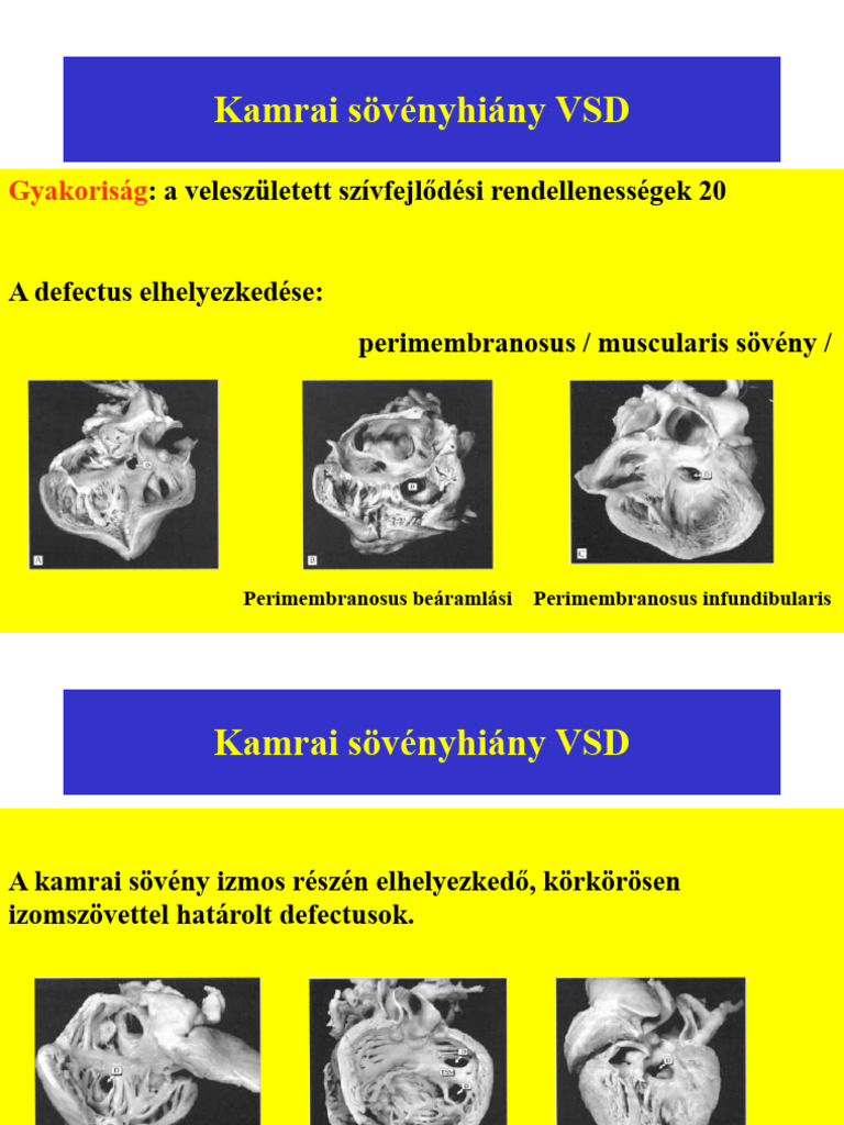 Kamrai sövényhiány VSD | PDF