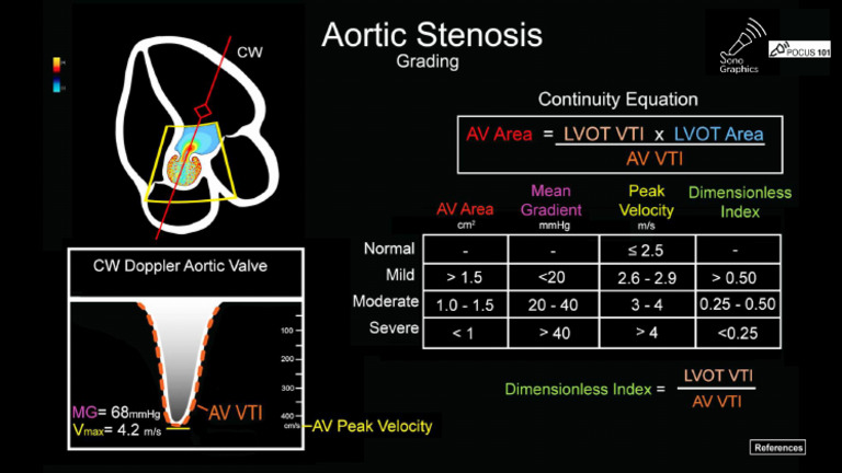 Aortic Stenosis Grading | PDF