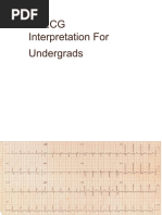 Delta Wave in ECG: WPW Insights | PDF | Cardiac Electrophysiology ...
