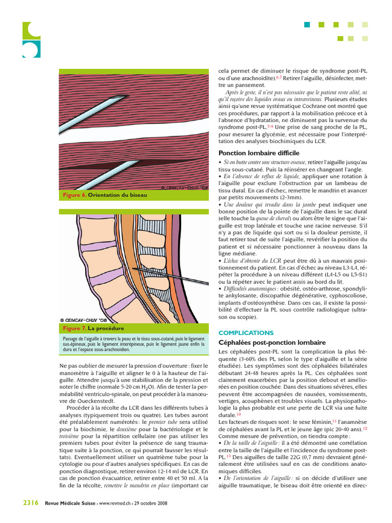 Techniques de ponction lombaire efficace | PDF | Médecine clinique ...