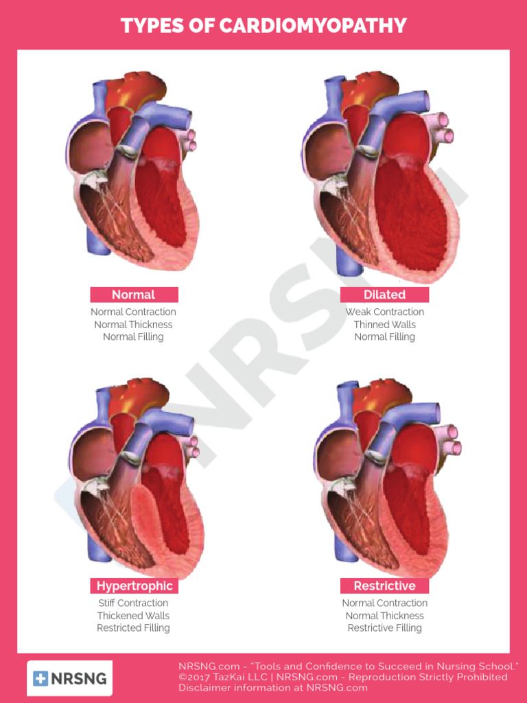 Types of Cardiomyopathy Guide | PDF