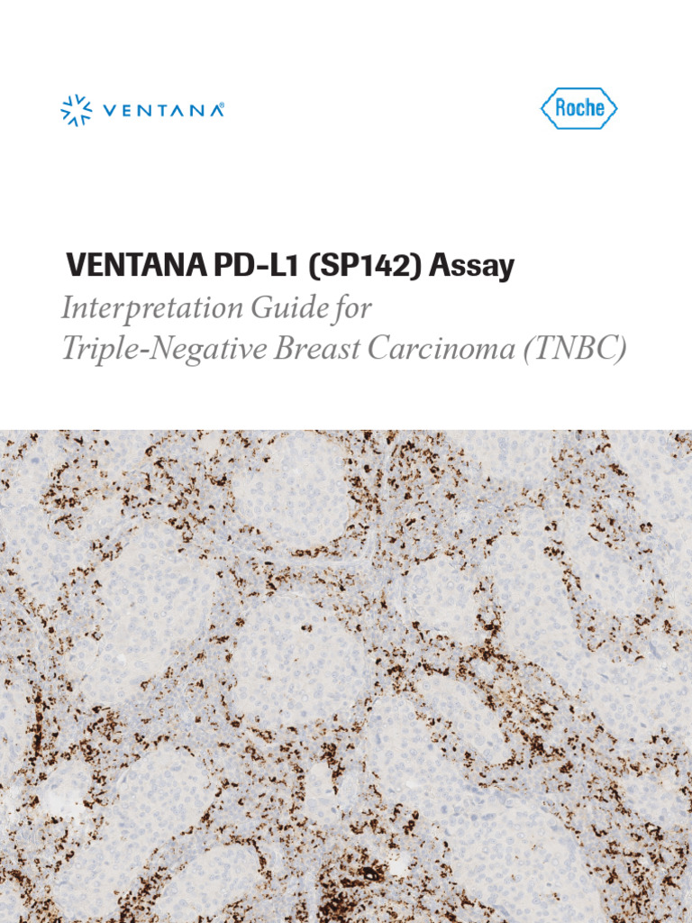 VENTANA PD L1 (SP142) Assay Interpretation Guide | PDF | Clinical ...
