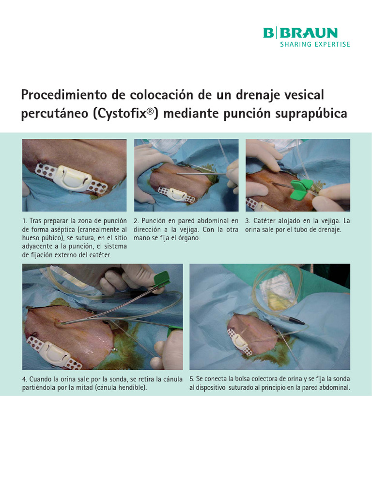 Procedimiento para La Colocacin de Cystofix | PDF