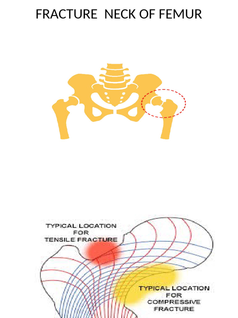 Neck of Femur Fractures: Overview & Treatment | PDF