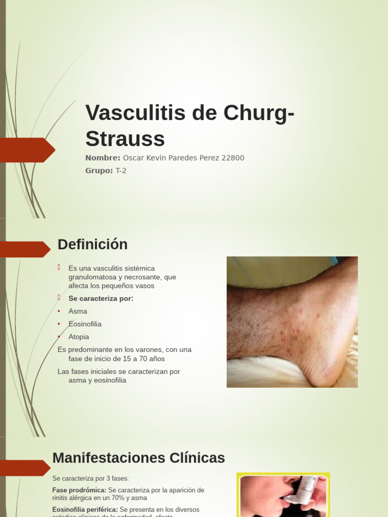 Vasculitis Churg-Strauss: Síntomas y Tratamiento | PDF
