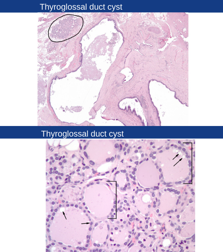 Thyroglossal duct cyst | PDF