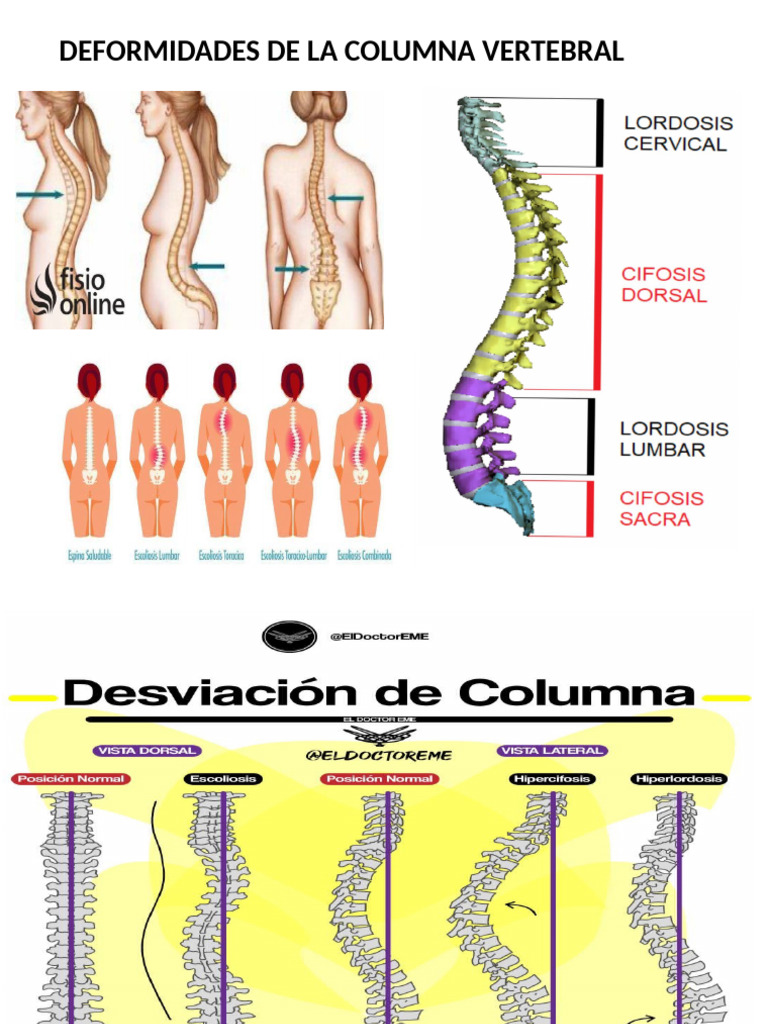 Deformidades de Columna | PDF