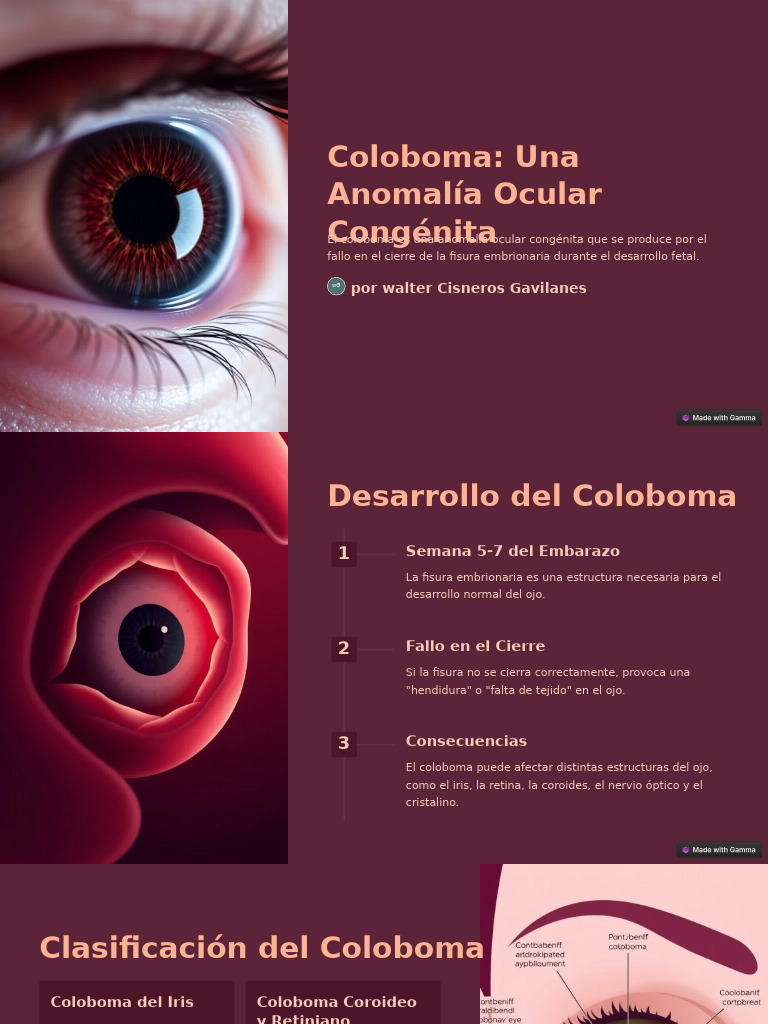 Coloboma: Anomalía Ocular Congénita | PDF | Ojo humano | Percepción visual