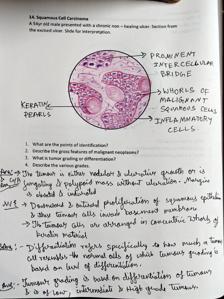patho 3 | PDF | Neoplasms | Carcinoma